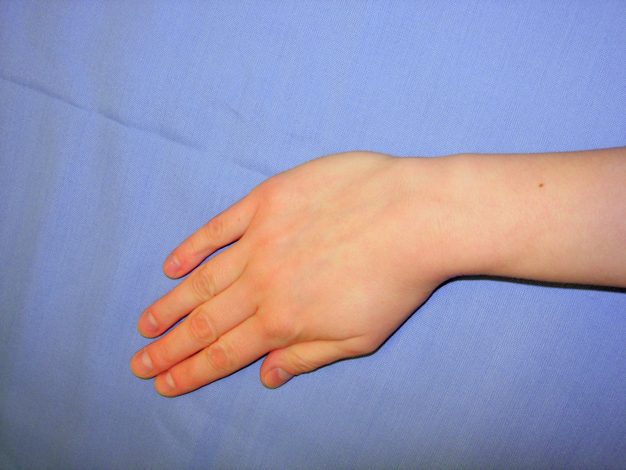 Sklerodermi - trening av hender - Helse Bergen HF